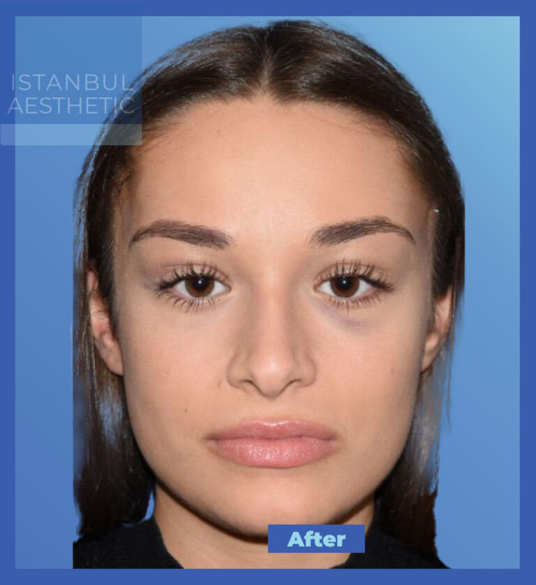 Tummy Tuck Surgery Istanbul Aesthetic Center 2653